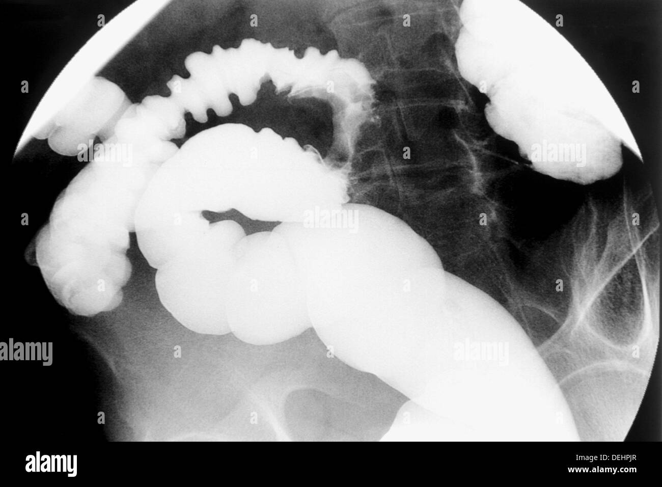 Cancer colon Black and White Stock Photos & Images - Alamy
