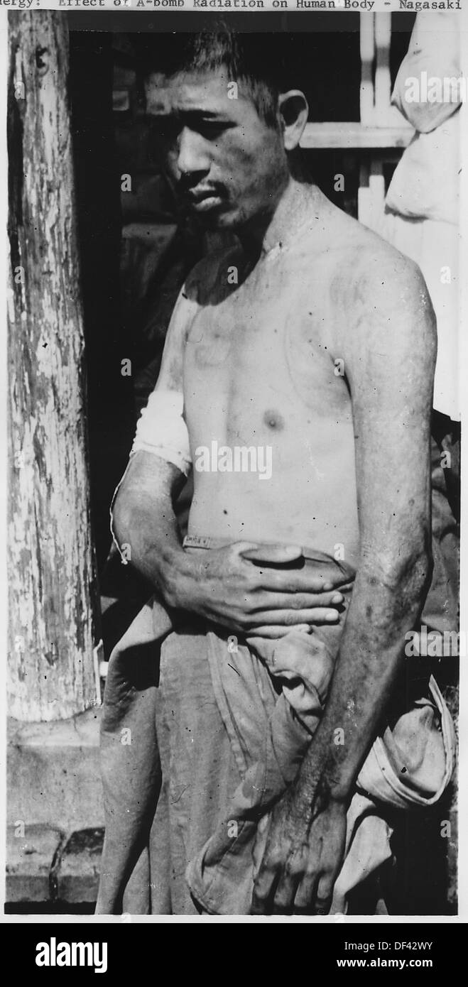 Radiation burns hiroshima hi-res stock photography and images - Alamy