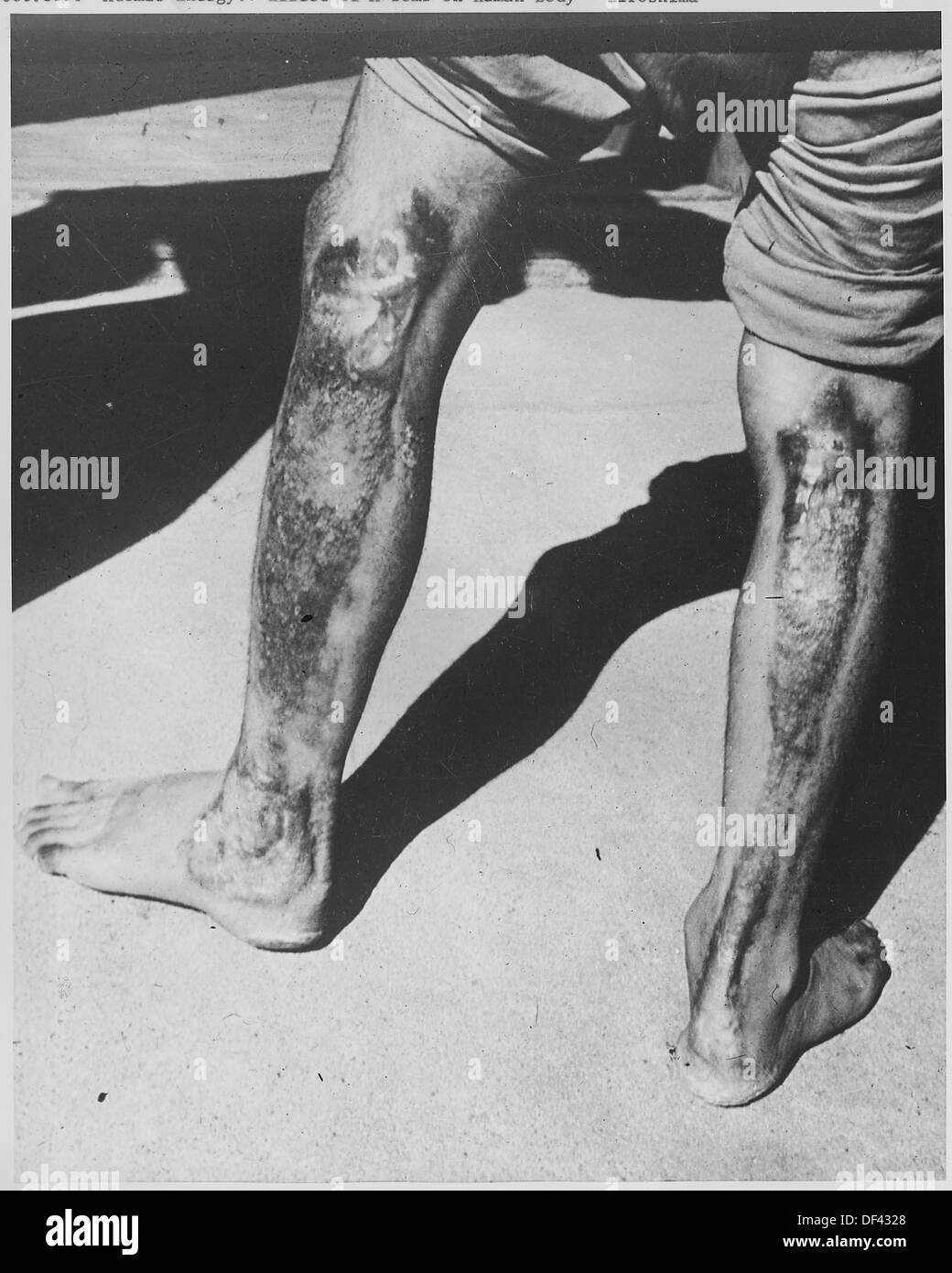 Radiation burns hiroshima hi-res stock photography and images - Alamy