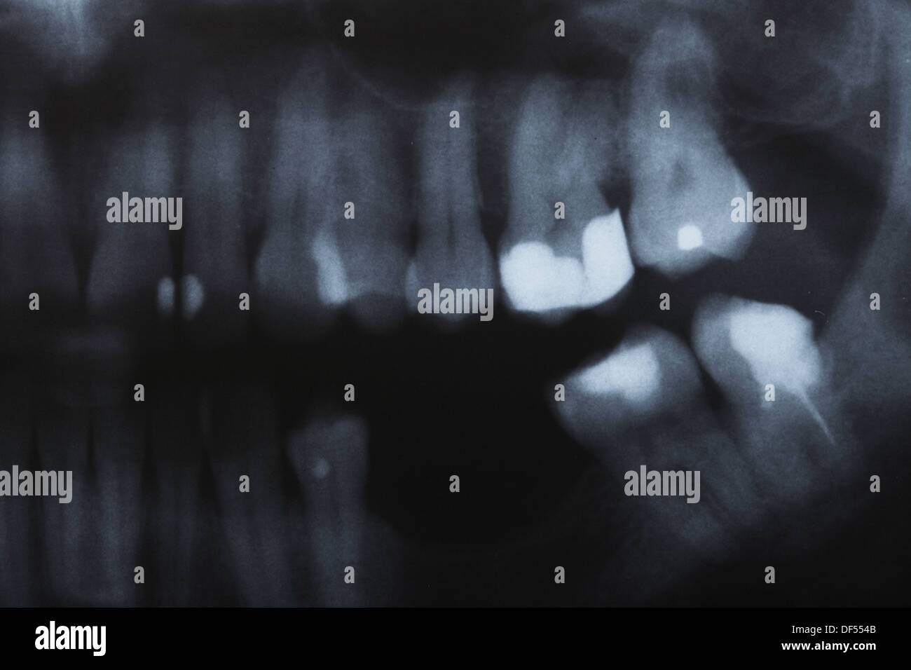 detail x-ray image scan of humans teeth Stock Photo - Alamy