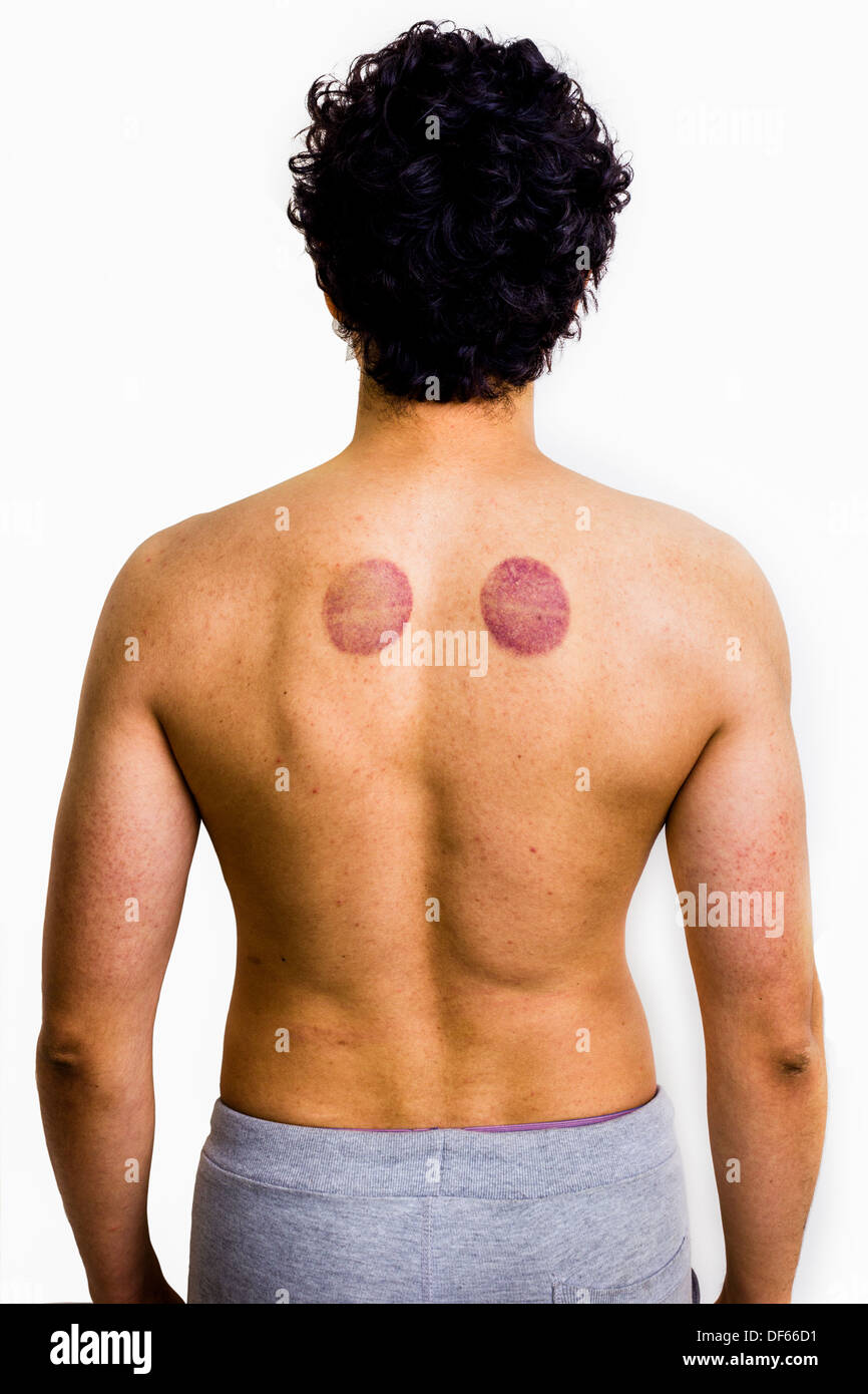 Rear view of young man with marks from acupuncture cupping therapy ...