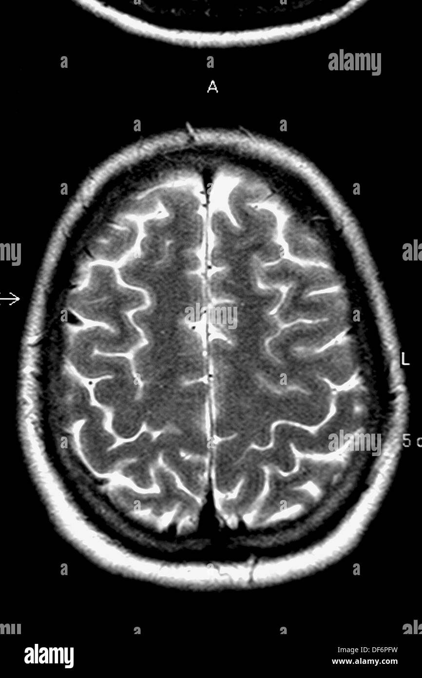 Brain Top View Mri