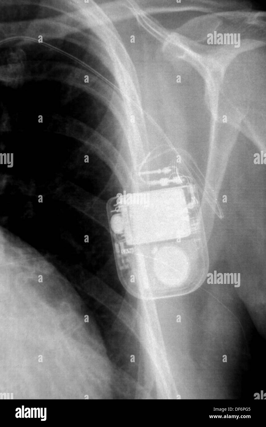 Pacemaker Black and White Stock Photos & Images - Alamy