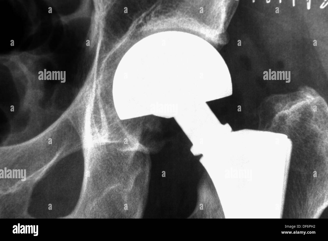 Hip prosthesis hi-res stock photography and images - Alamy