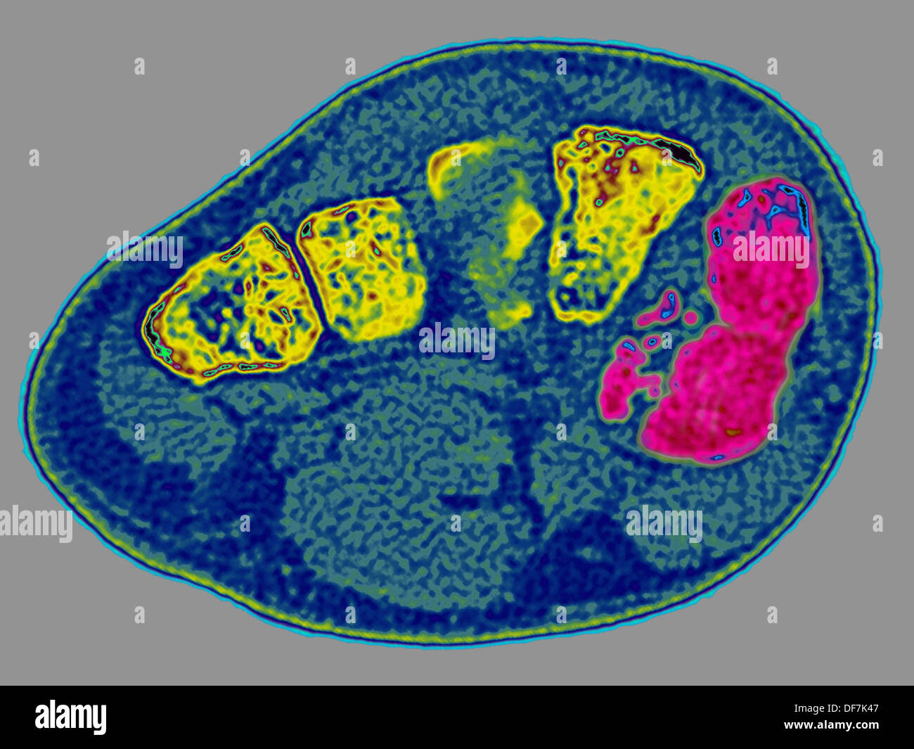 Radiograph foot hi-res stock photography and images - Alamy