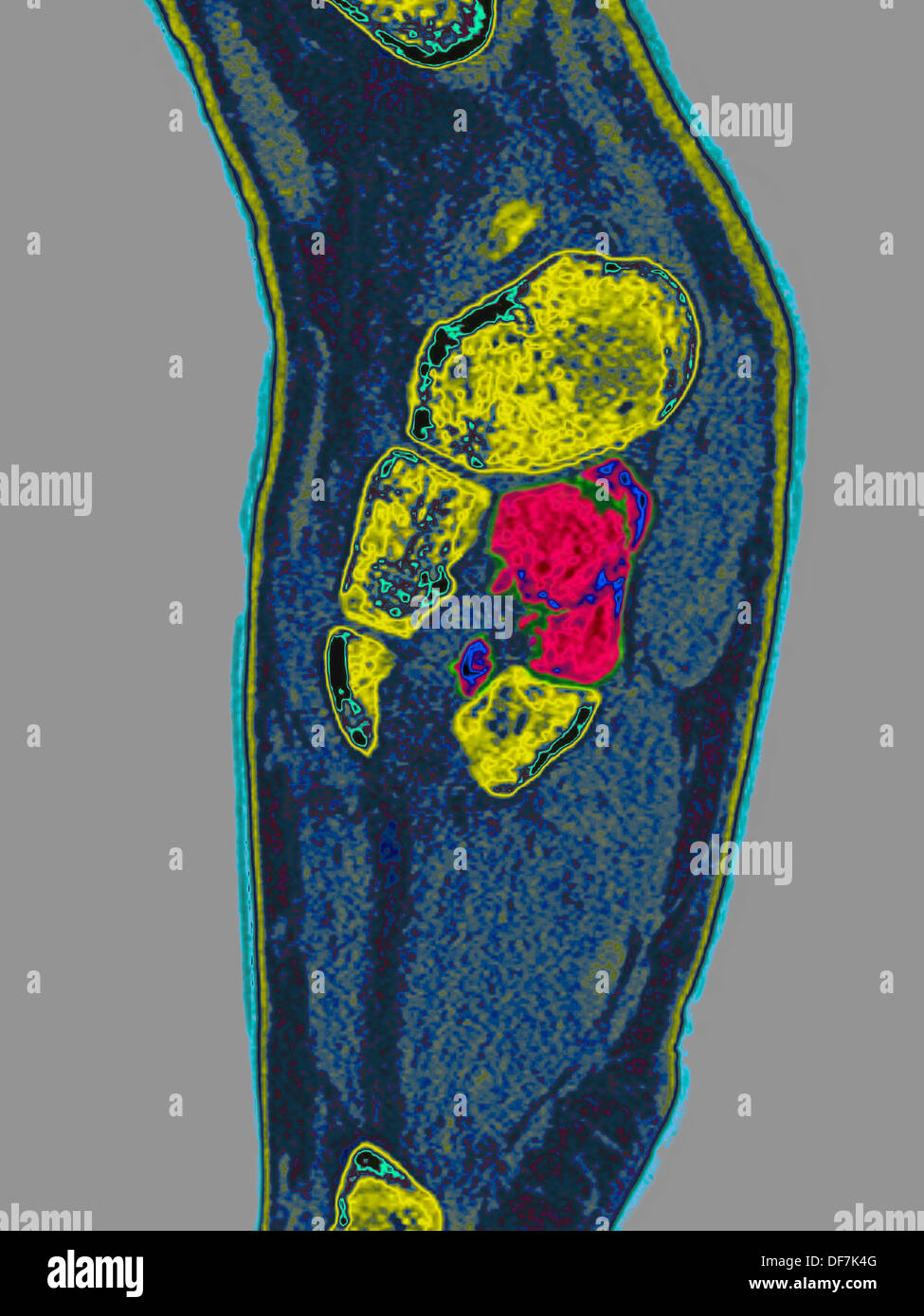 FRACTURED FOOT, SCAN Stock Photo - Alamy