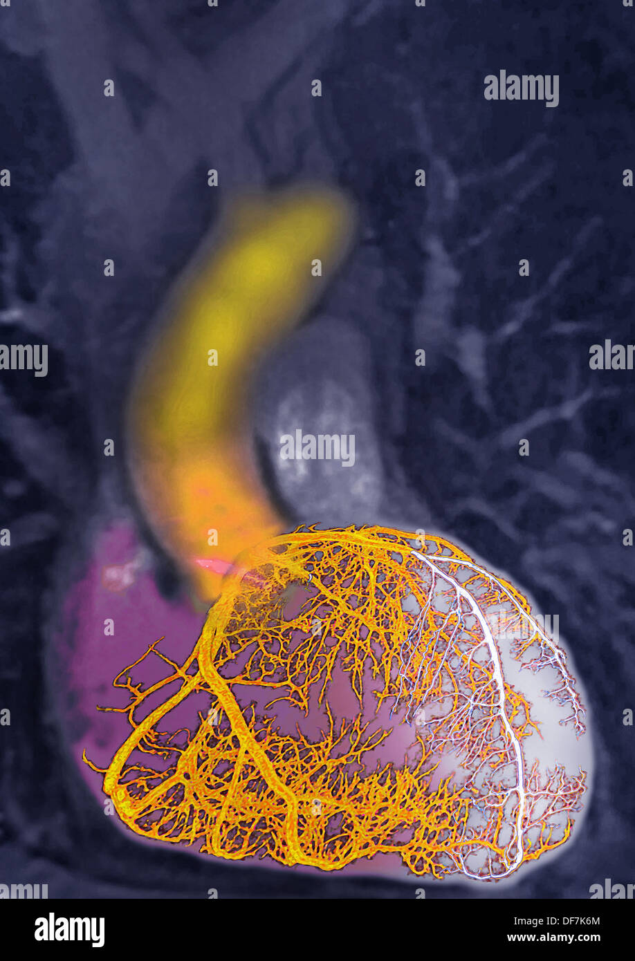 Myocardial Infarction Stock Photos & Myocardial Infarction Stock Images ...