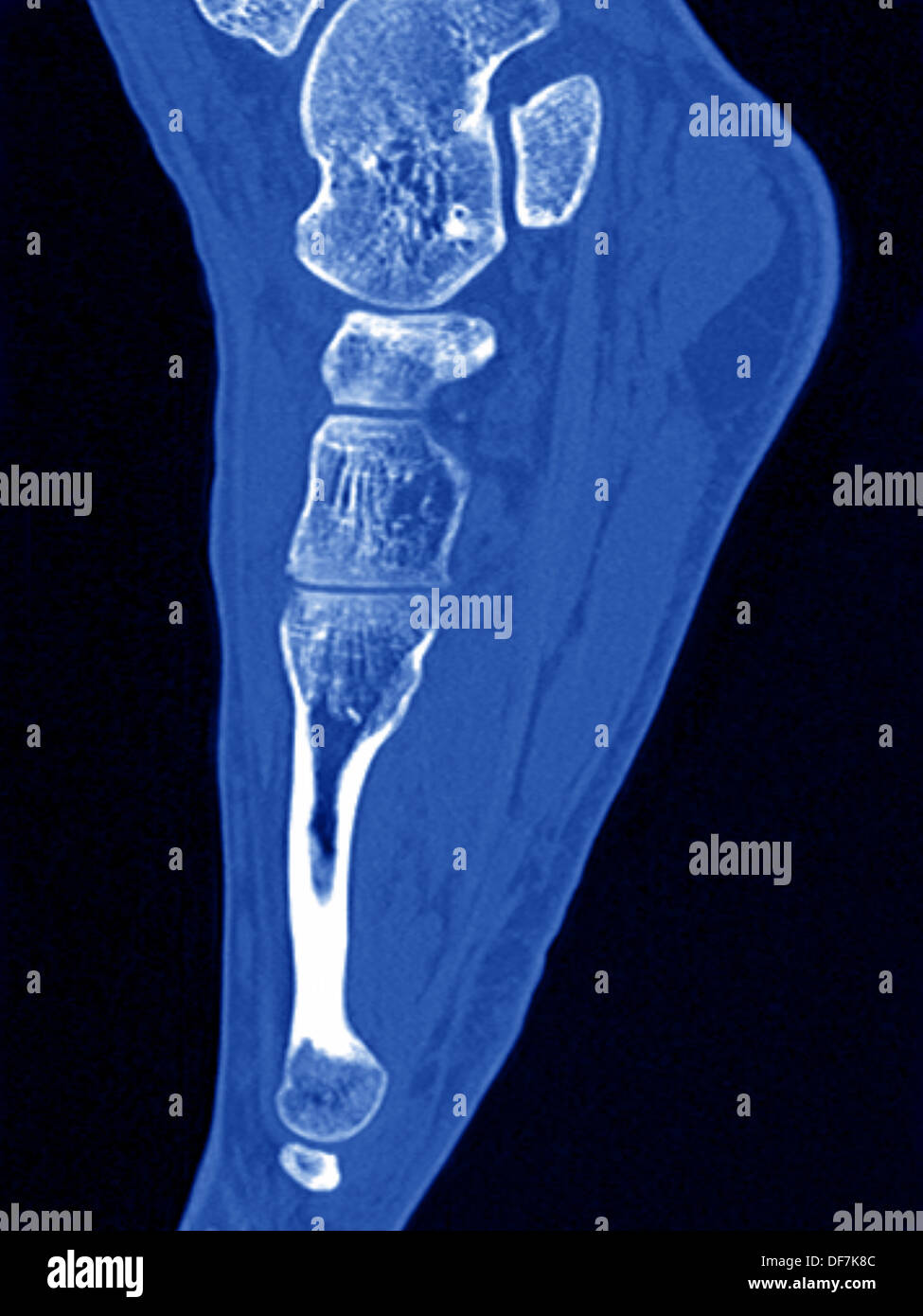 X ray normal foot hi-res stock photography and images - Alamy