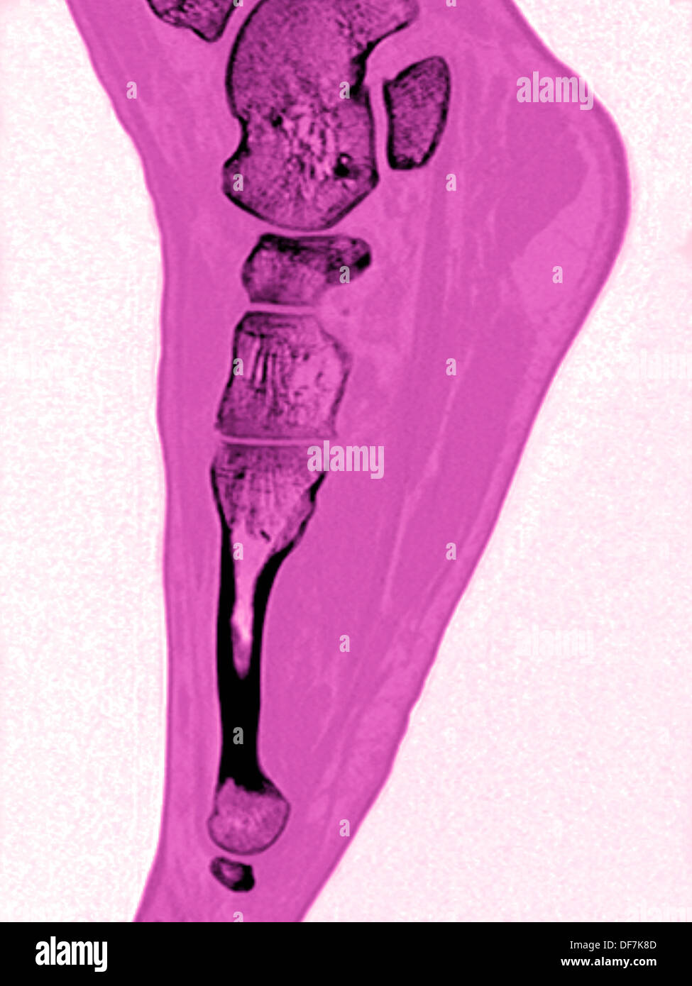 Normal Foot Stock Photos & Normal Foot Stock Images - Alamy