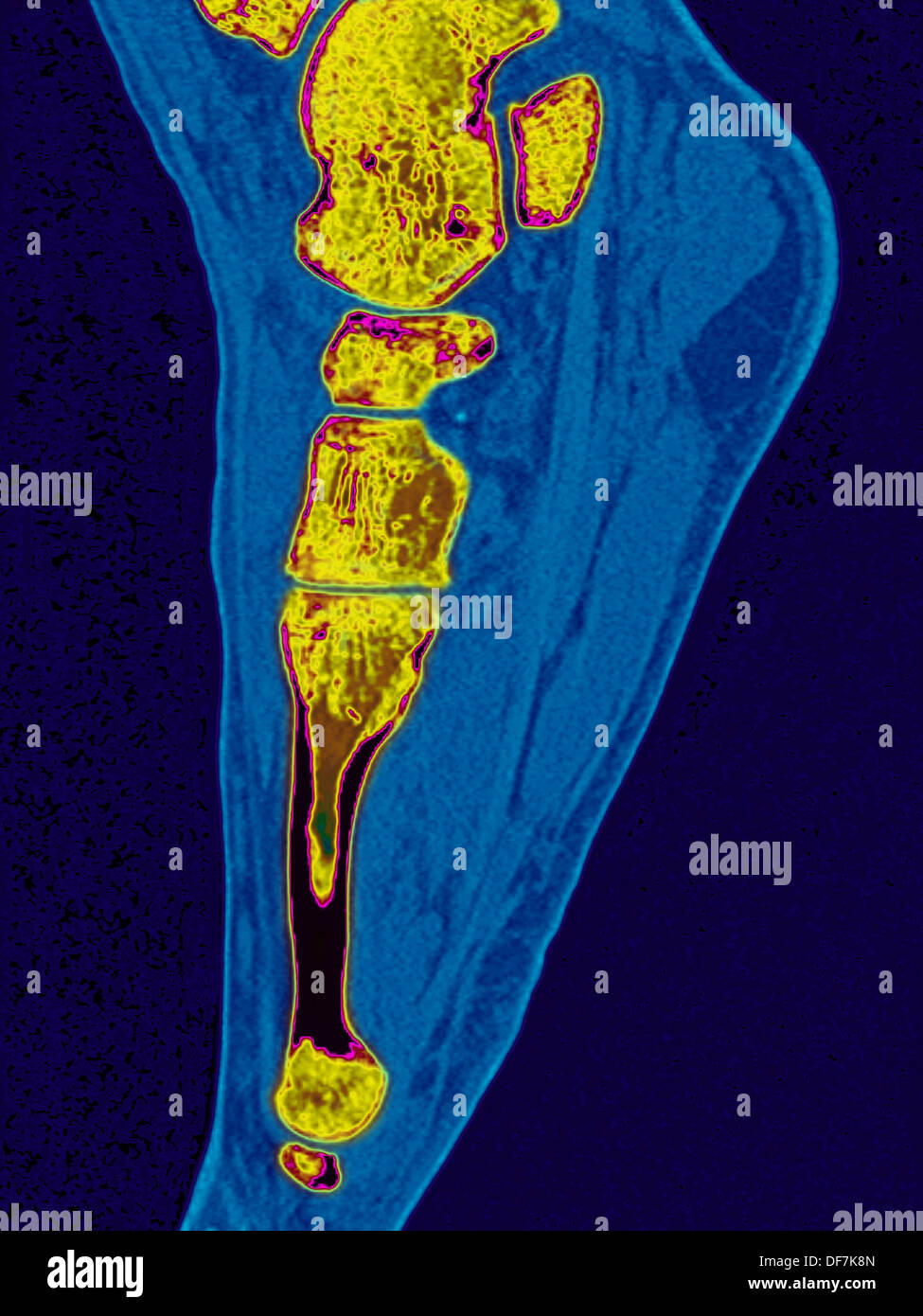 X ray normal foot hi-res stock photography and images - Alamy