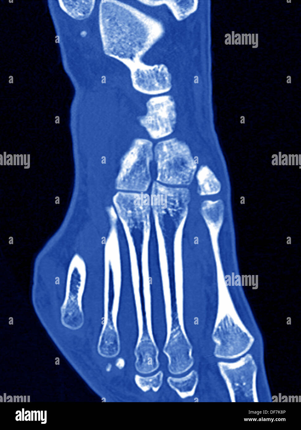 Normal Foot Stock Photos & Normal Foot Stock Images - Alamy