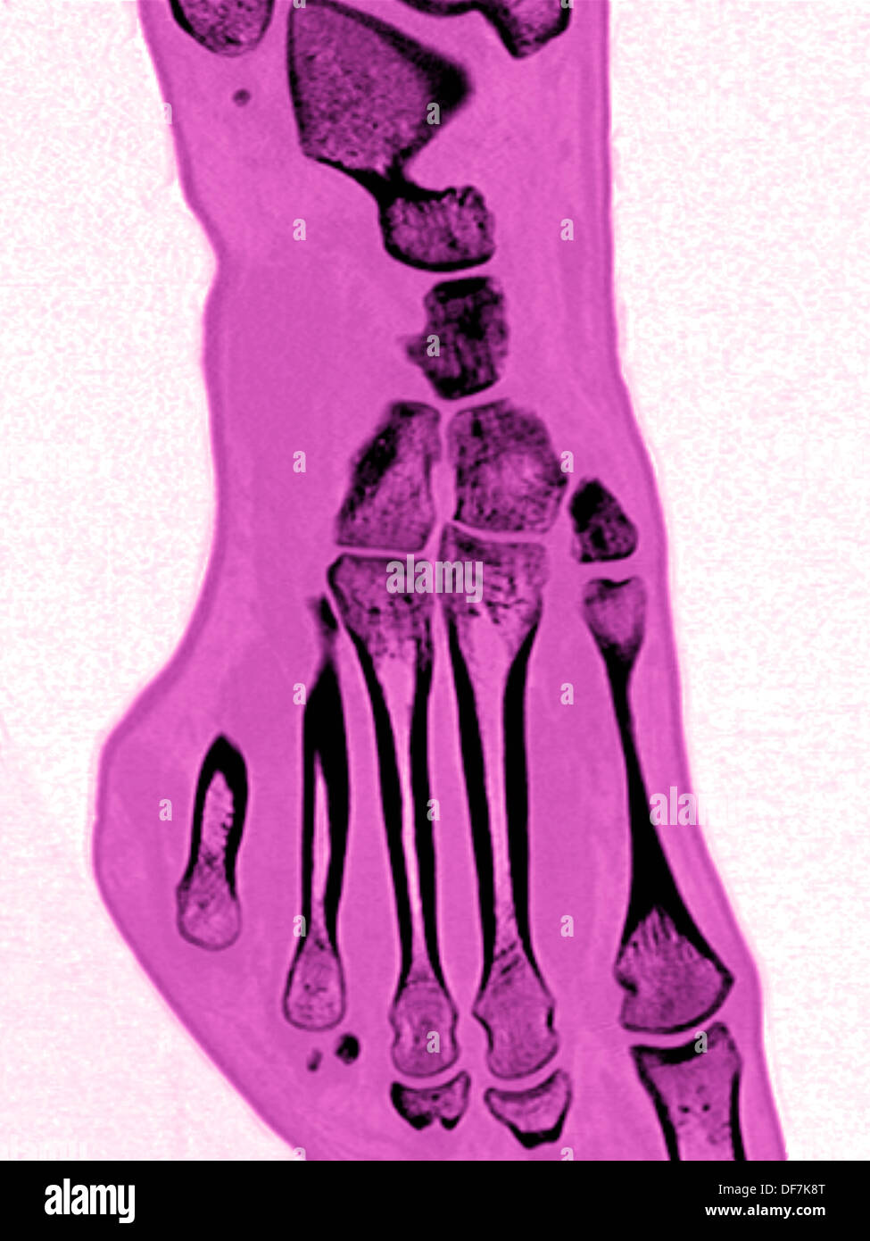 X ray normal foot hi-res stock photography and images - Alamy