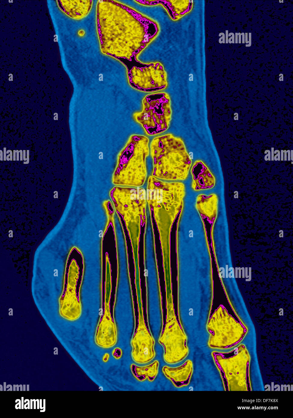 X ray normal foot hi-res stock photography and images - Alamy