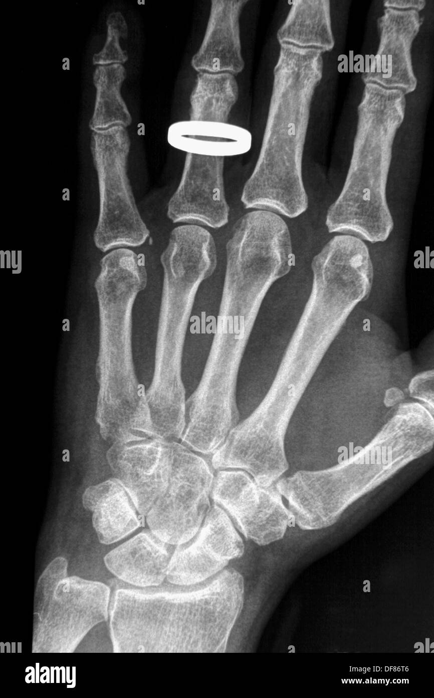 X ray hand ring hi-res stock photography and images - Alamy