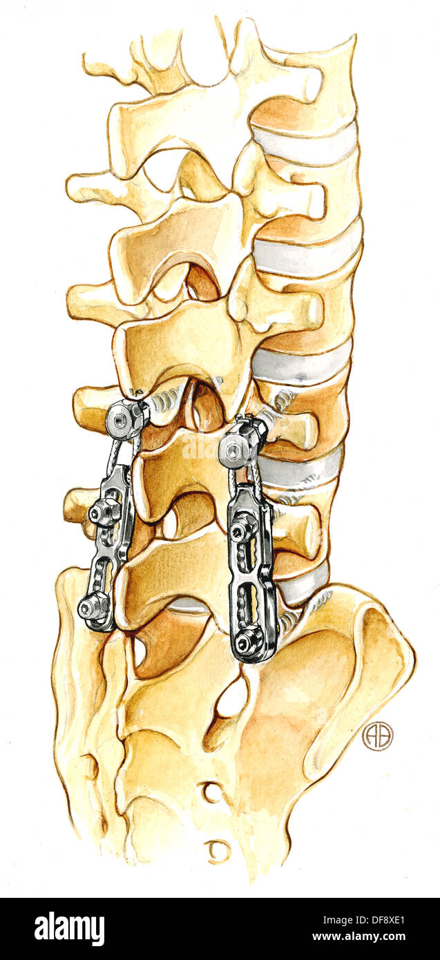 Bone fixator hi-res stock photography and images - Alamy