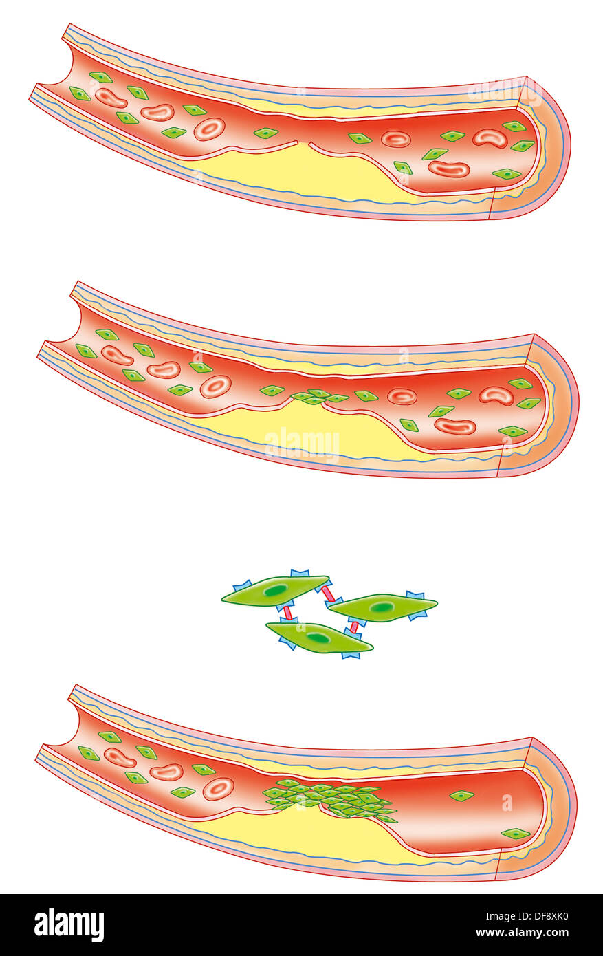 Arteriosclerosis drawing hi-res stock photography and images - Alamy