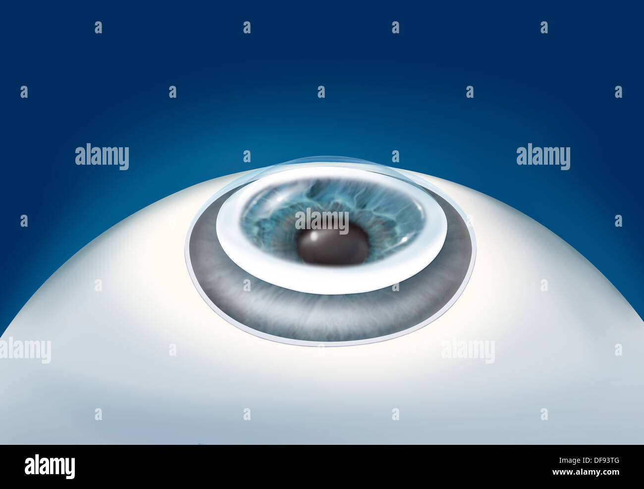 Cornea Transplant Video