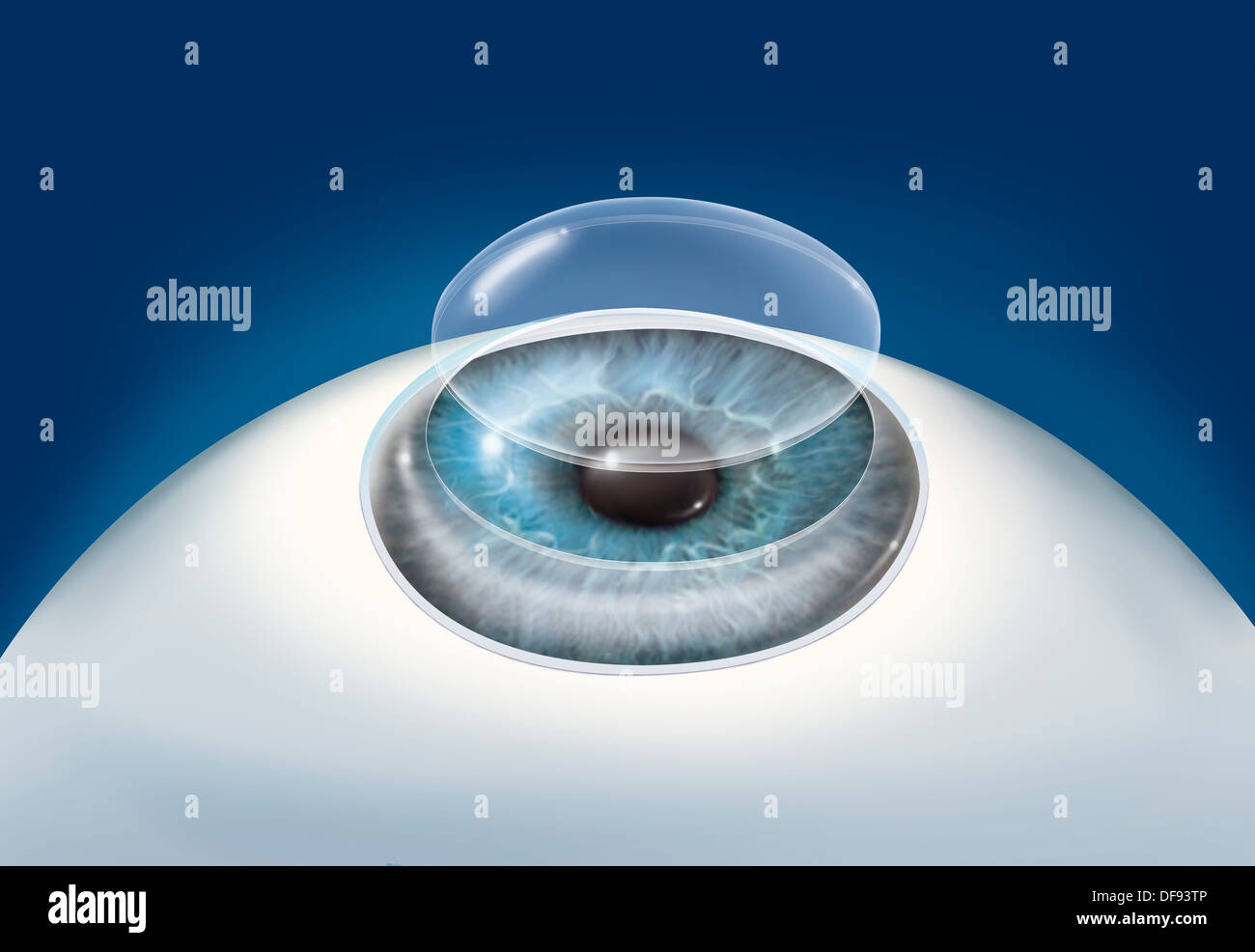 Cornea transplant hi-res stock photography and images - Alamy