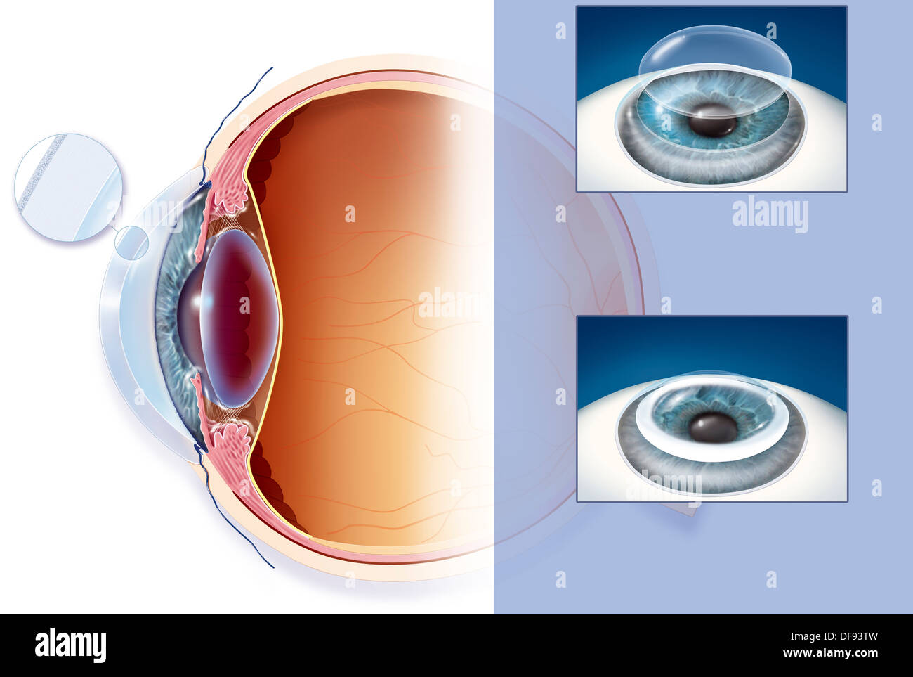 Cornea transplant hi-res stock photography and images - Alamy