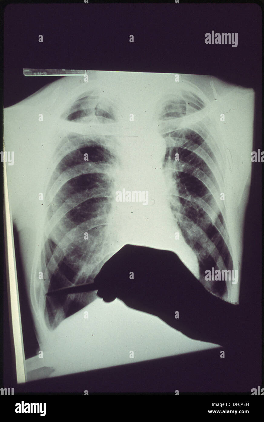 An image showing a lung severely damaged by emphysema, visibly larger ...