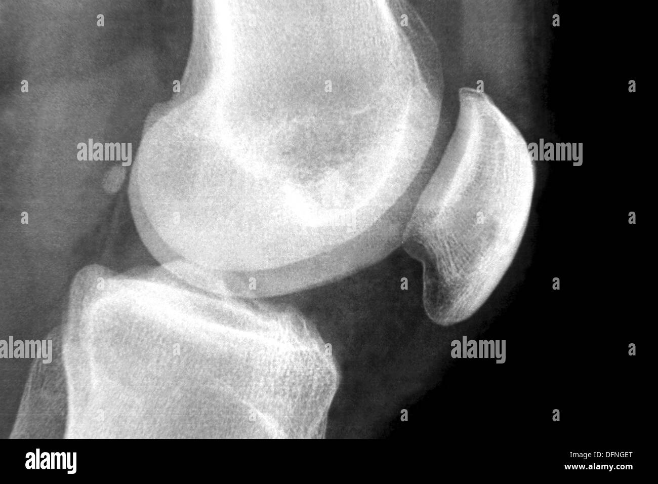 Knee radiography Black and White Stock Photos & Images - Alamy