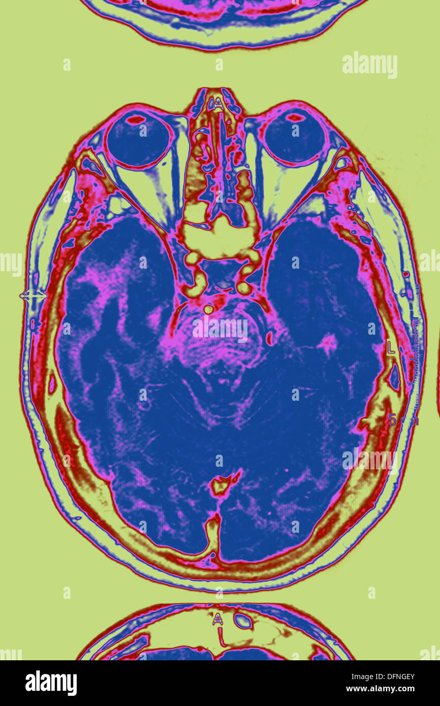 Brain anatomy axial hi-res stock photography and images - Alamy