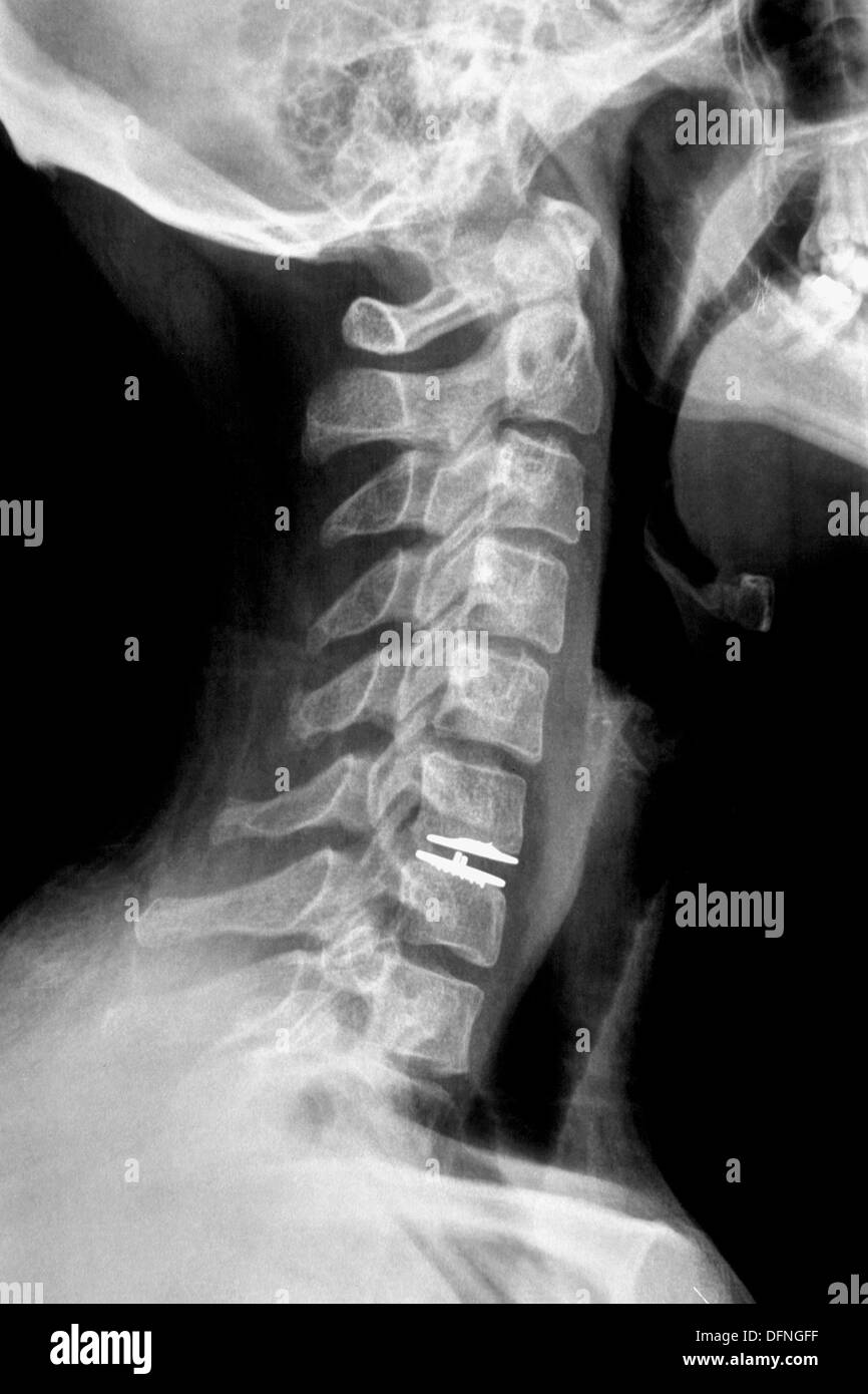 Cervical vertebra x ray Black and White Stock Photos & Images - Alamy