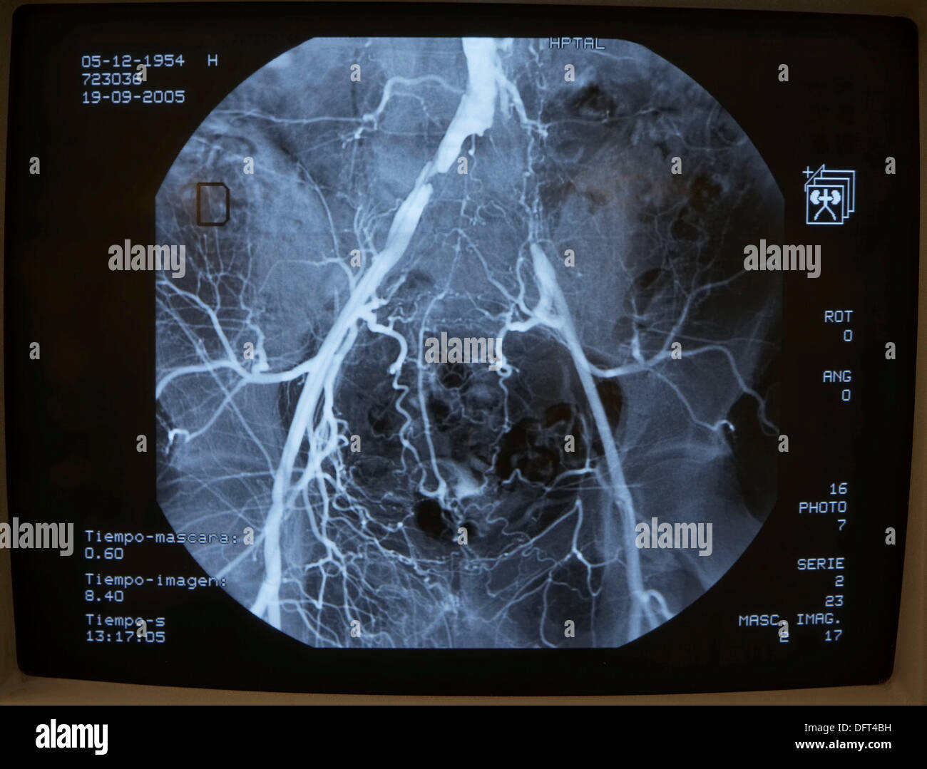 Angiography, implantation of stent or coronary endoprosthesis ...