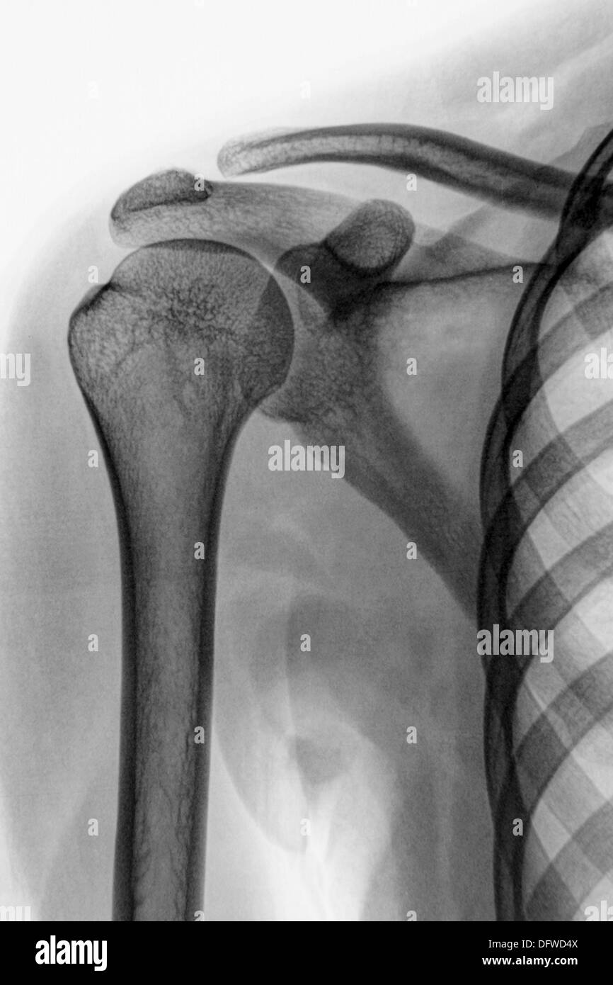 Shoulder blade arm bones scapula hi-res stock photography and images ...