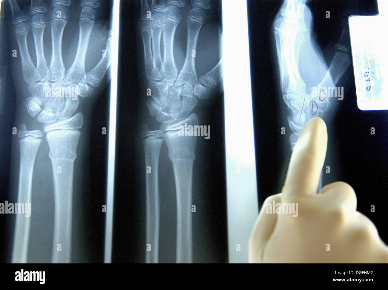 Close Up X Ray Human Wrist Hand High Resolution Stock Photography and ...