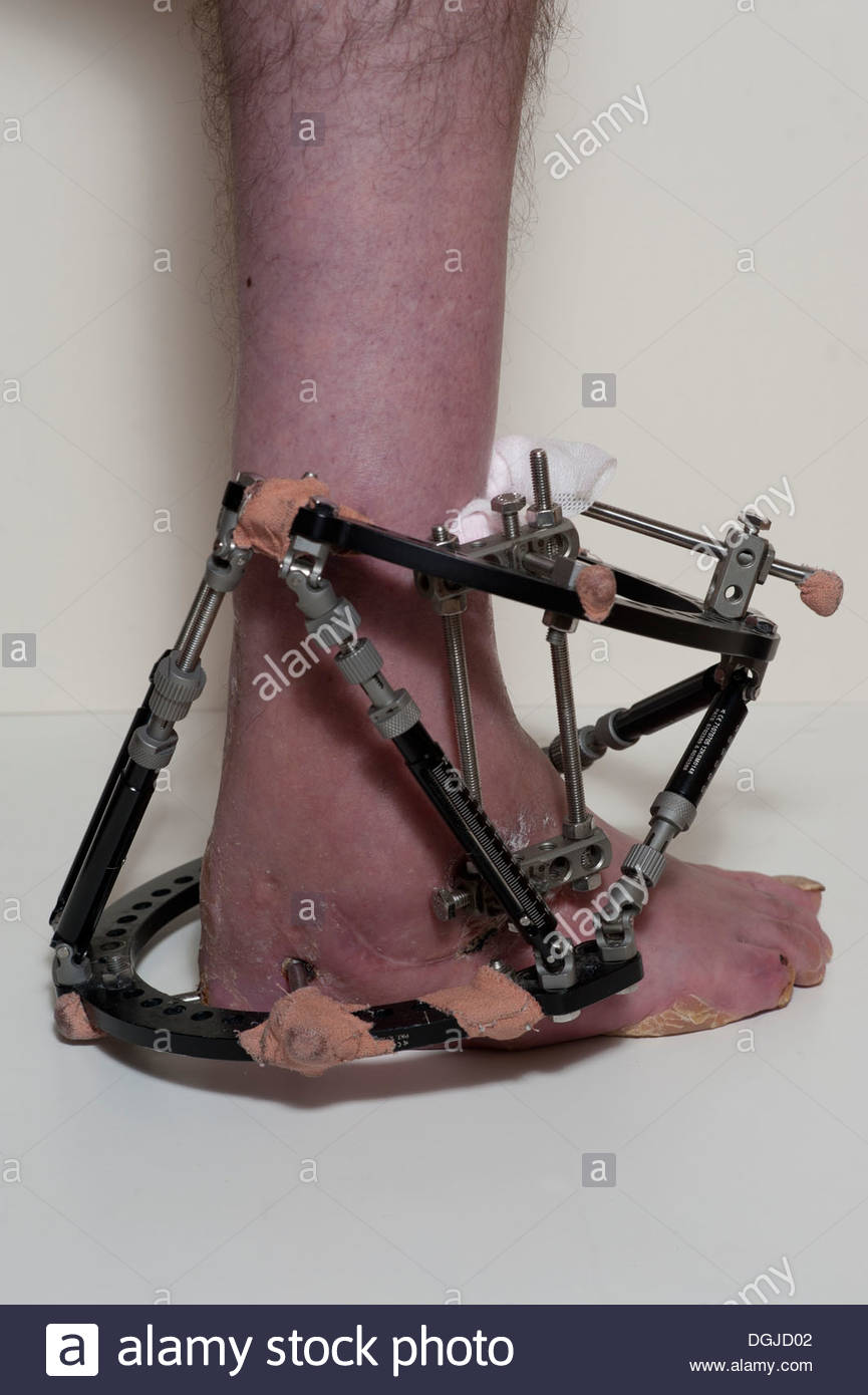 Achilles Tendon Stock Photos & Achilles Tendon Stock Images - Alamy