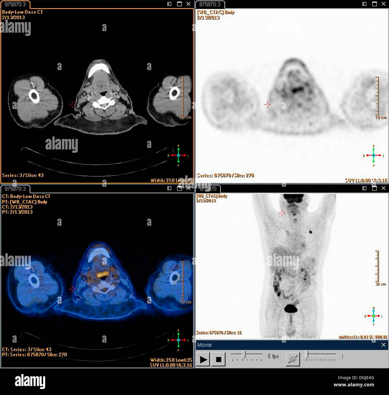 Positron Emission Tomography Scan
