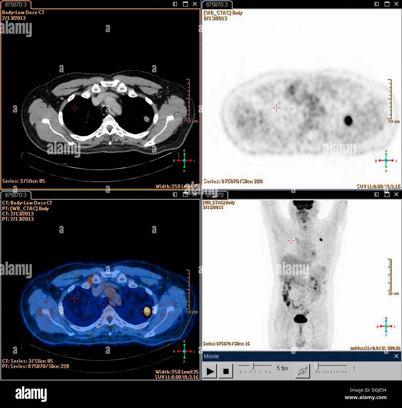 Pet scan cancer hi-res stock photography and images - Alamy