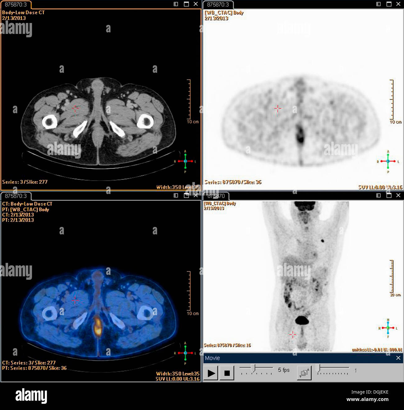 Positron emission tomography scan hi-res stock photography and images ...