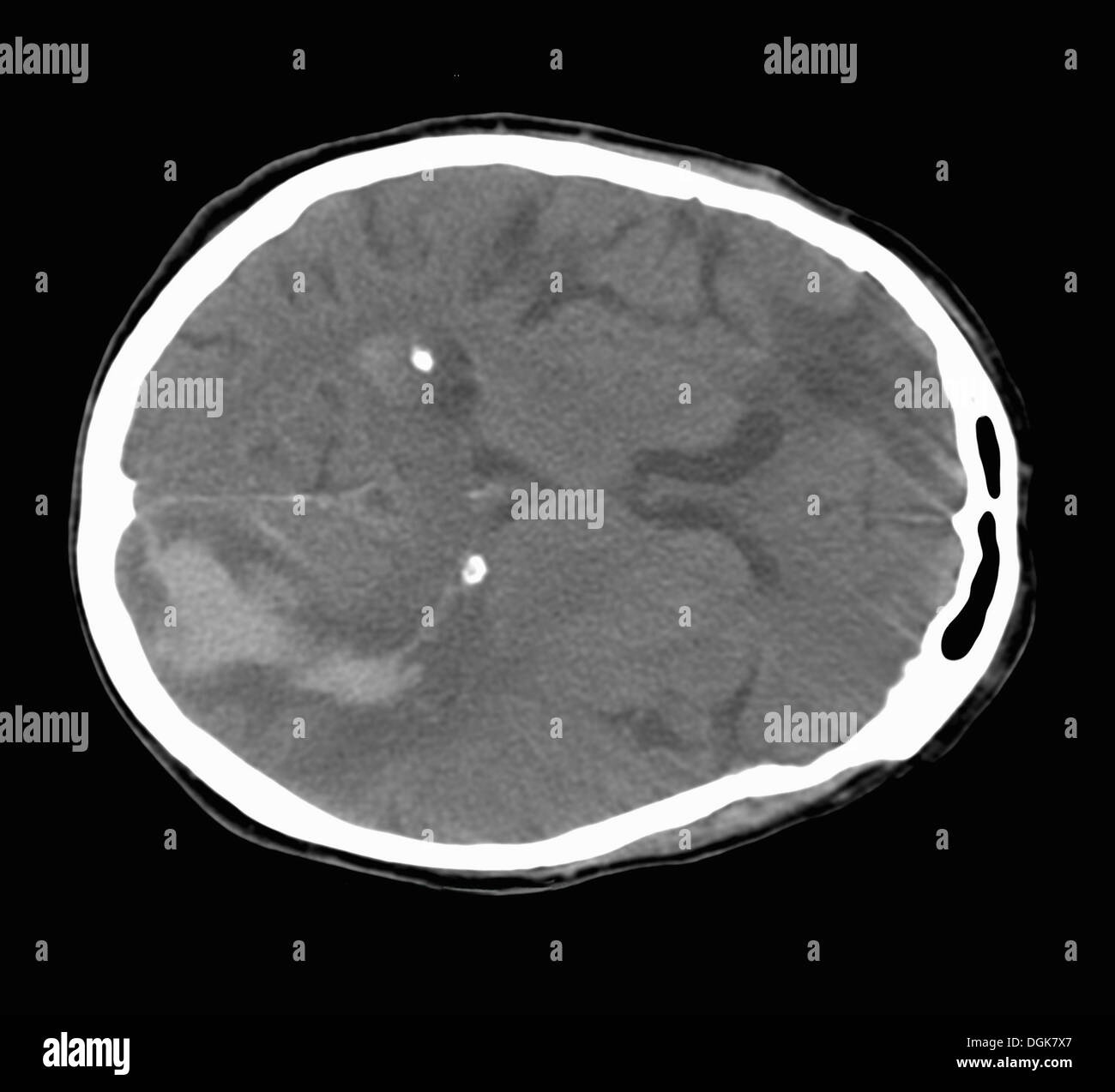 Stroke Brain Scan Stock Photos & Stroke Brain Scan Stock Images - Alamy