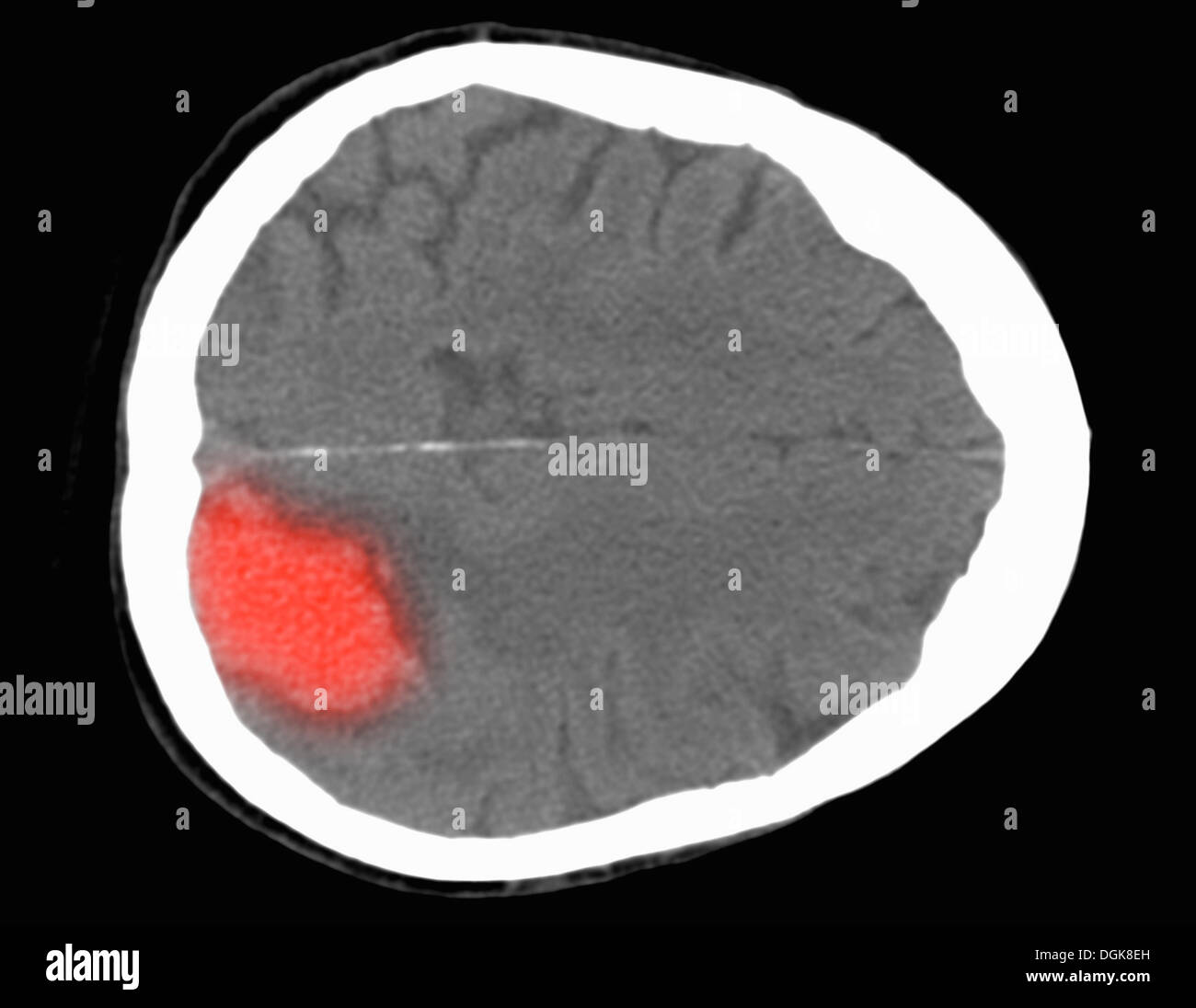 Hemorrhage, brain scan hi-res stock photography and images - Alamy