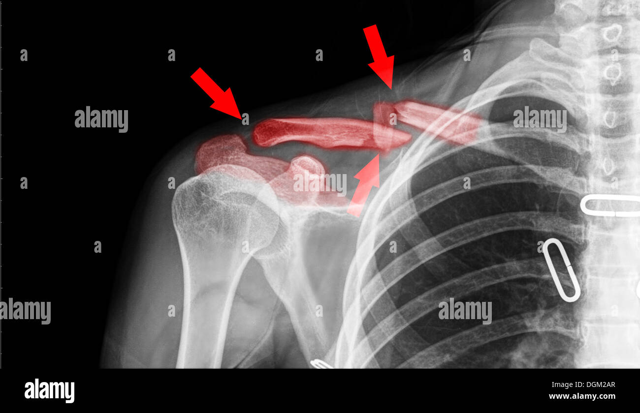 X-radiation (composed of X-rays) is a form of electromagnetic radiation ...