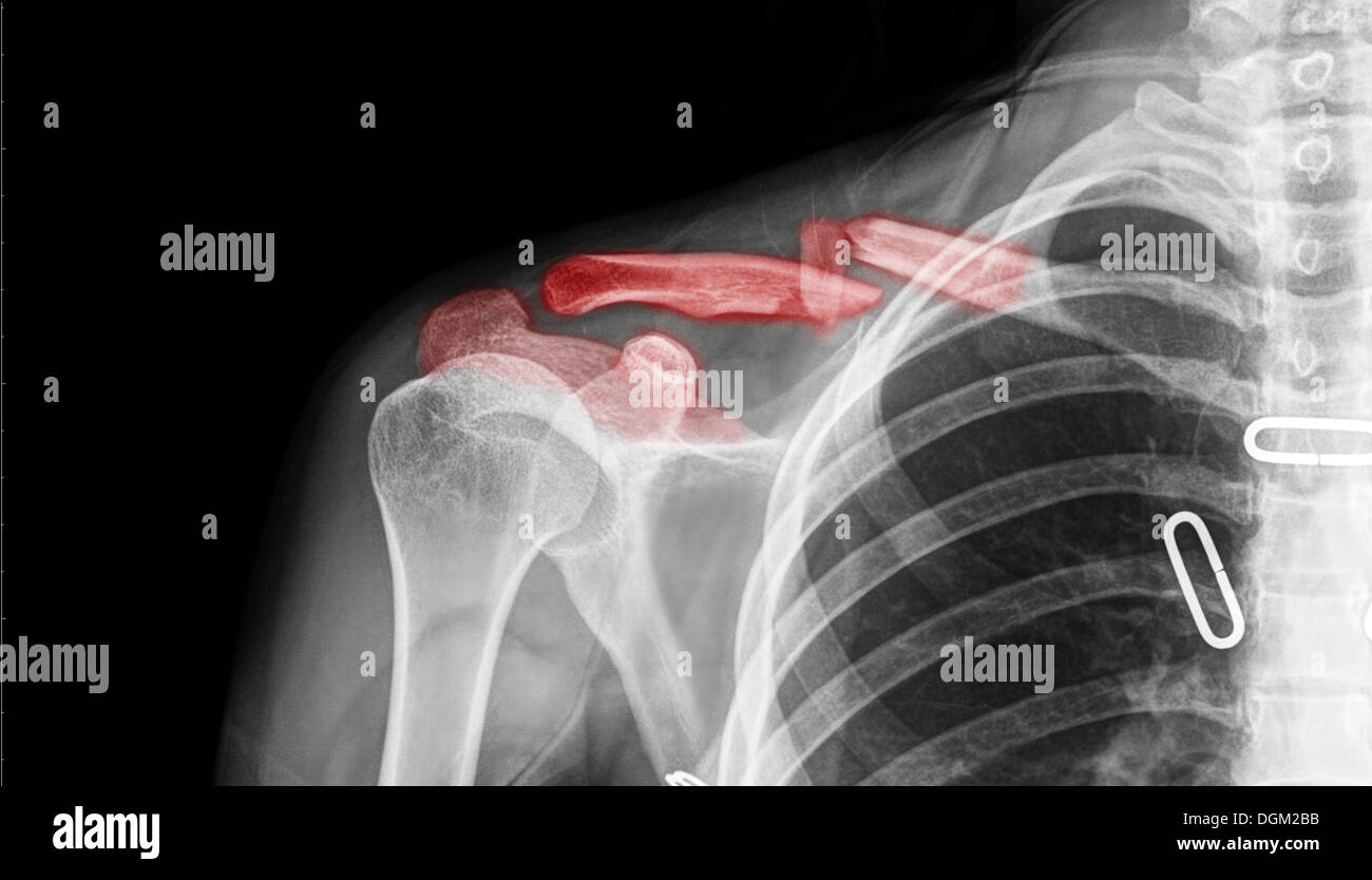 X-radiation (composed of X-rays) is a form of electromagnetic radiation ...