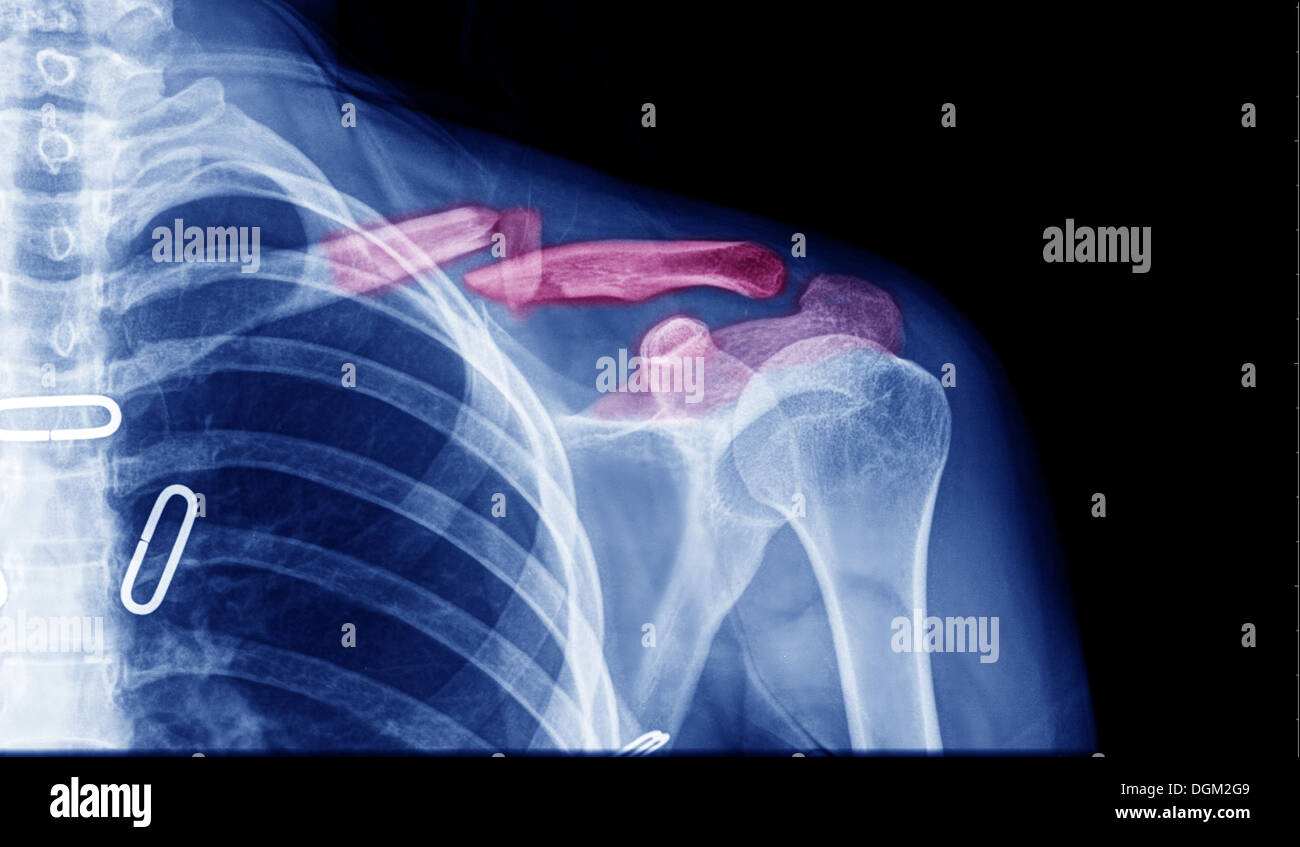 X-radiation (composed of X-rays) is a form of electromagnetic radiation ...