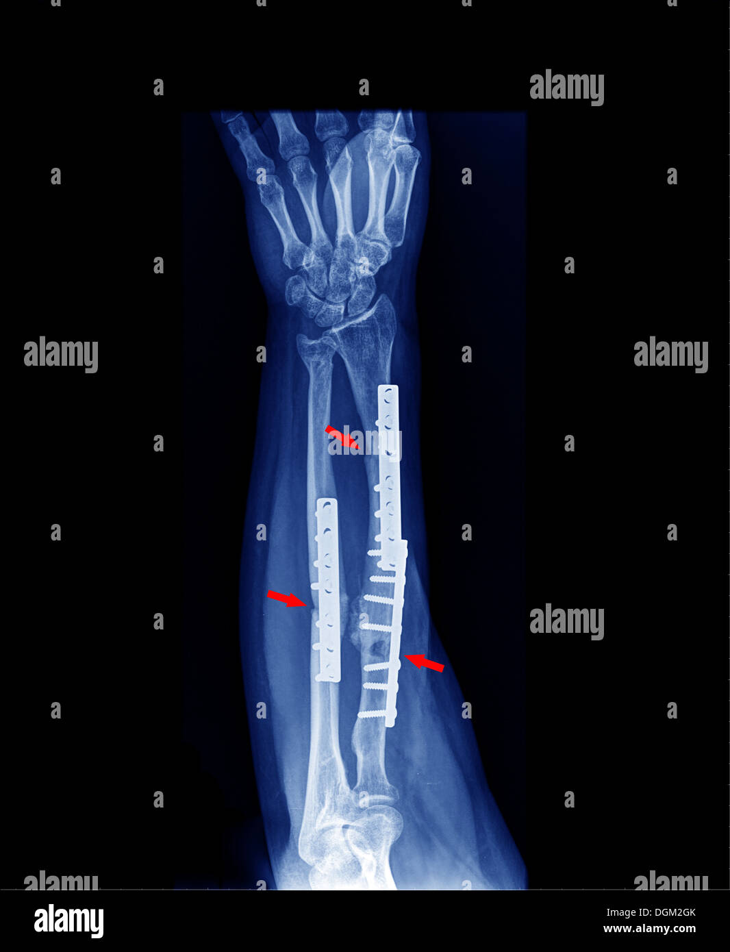 X-radiation (composed of X-rays) is a form of electromagnetic radiation ...