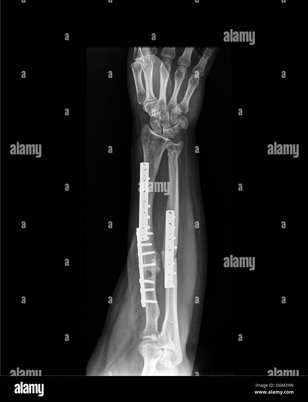 X-radiation (composed of X-rays) is a form of electromagnetic radiation ...