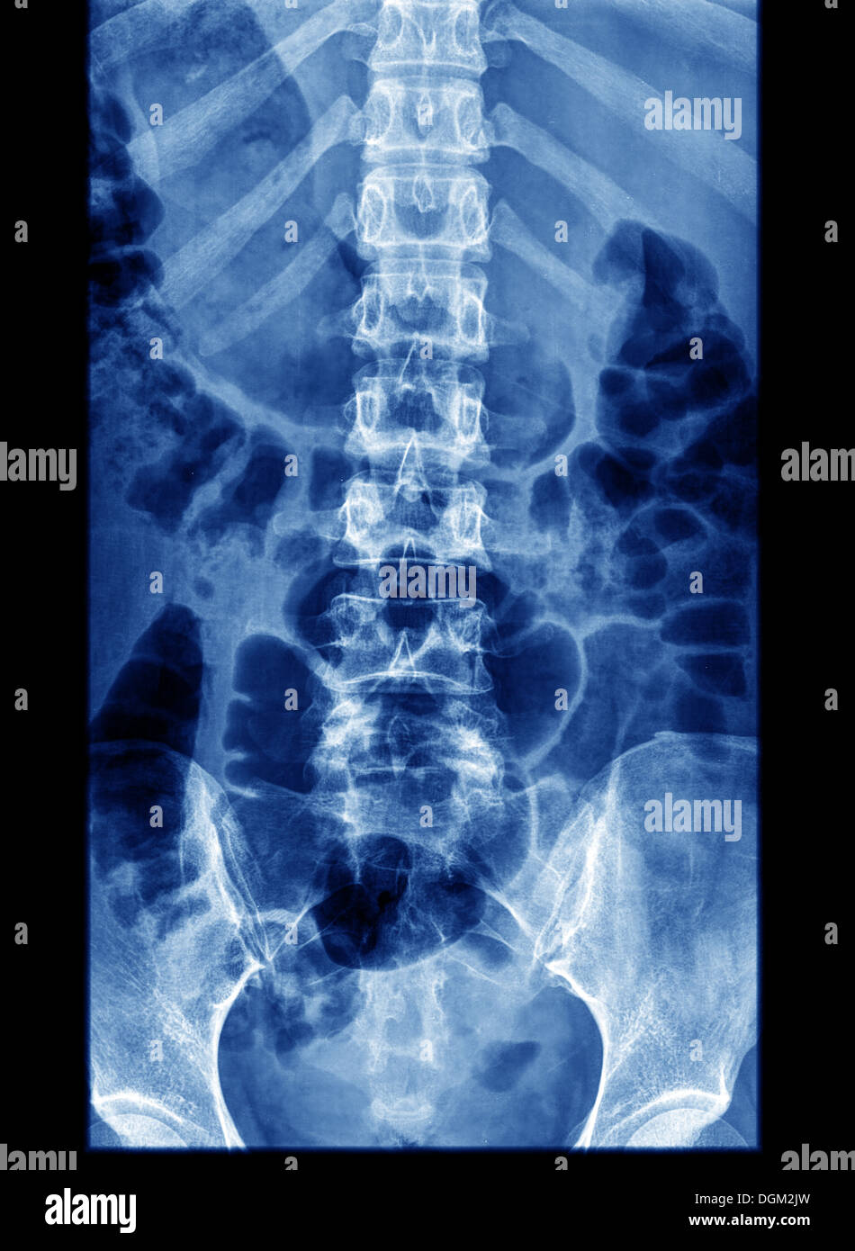 X-radiation (composed of X-rays) is a form of electromagnetic radiation ...