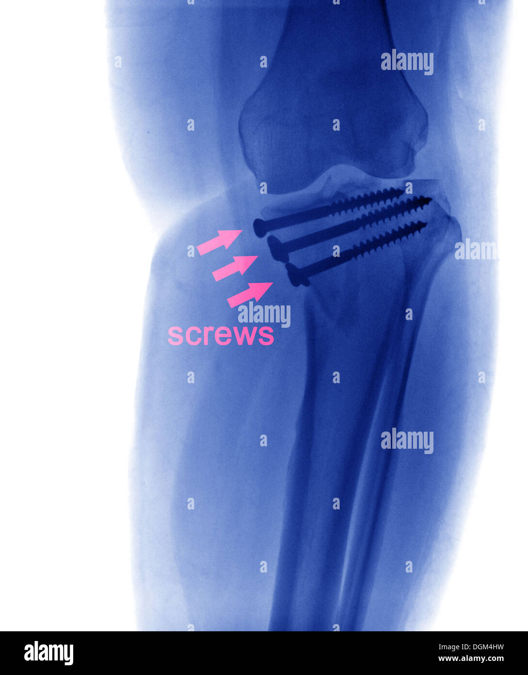 X-radiation (composed of X-rays) is a form of electromagnetic radiation ...