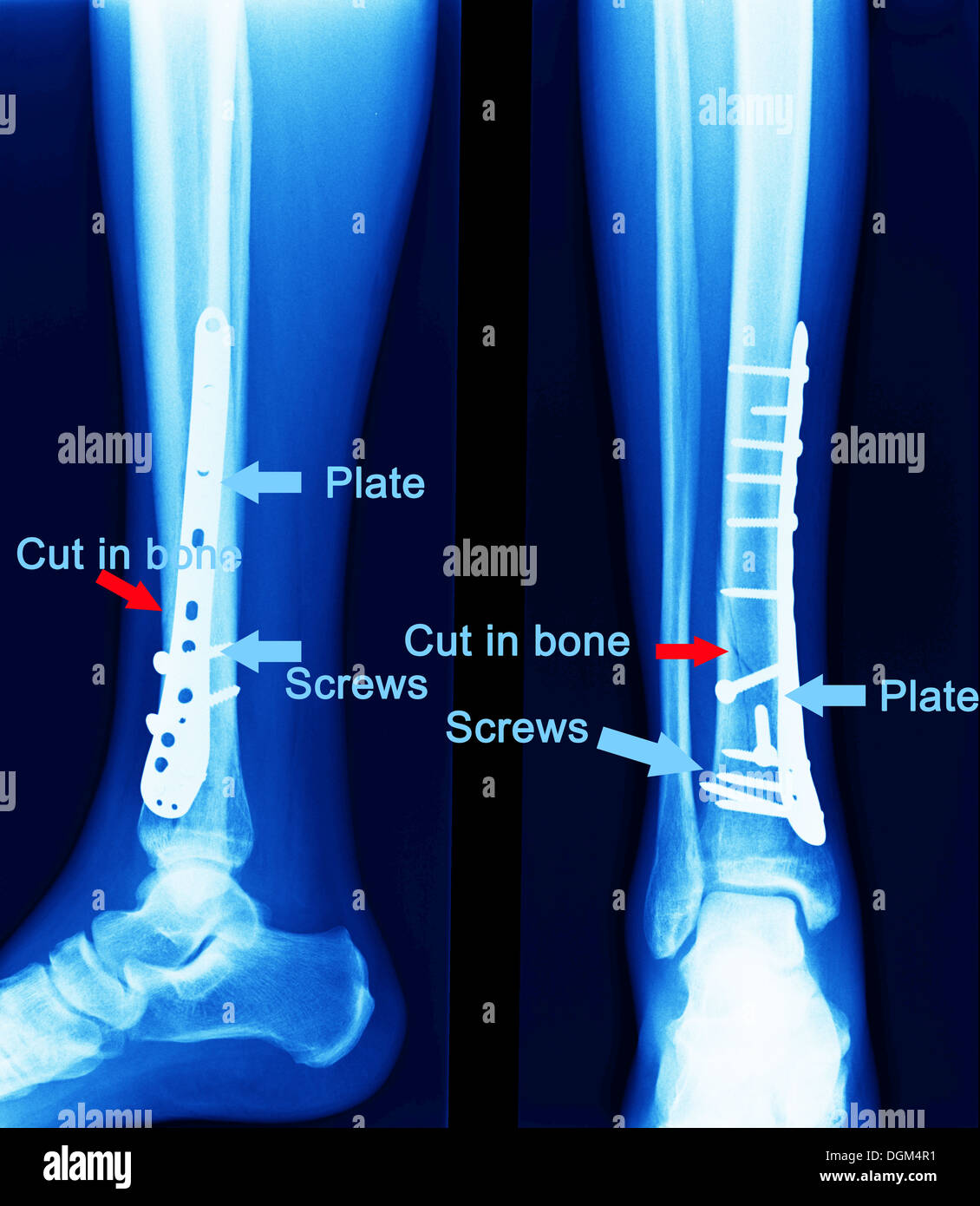 X-radiation (composed of X-rays) is a form of electromagnetic radiation ...
