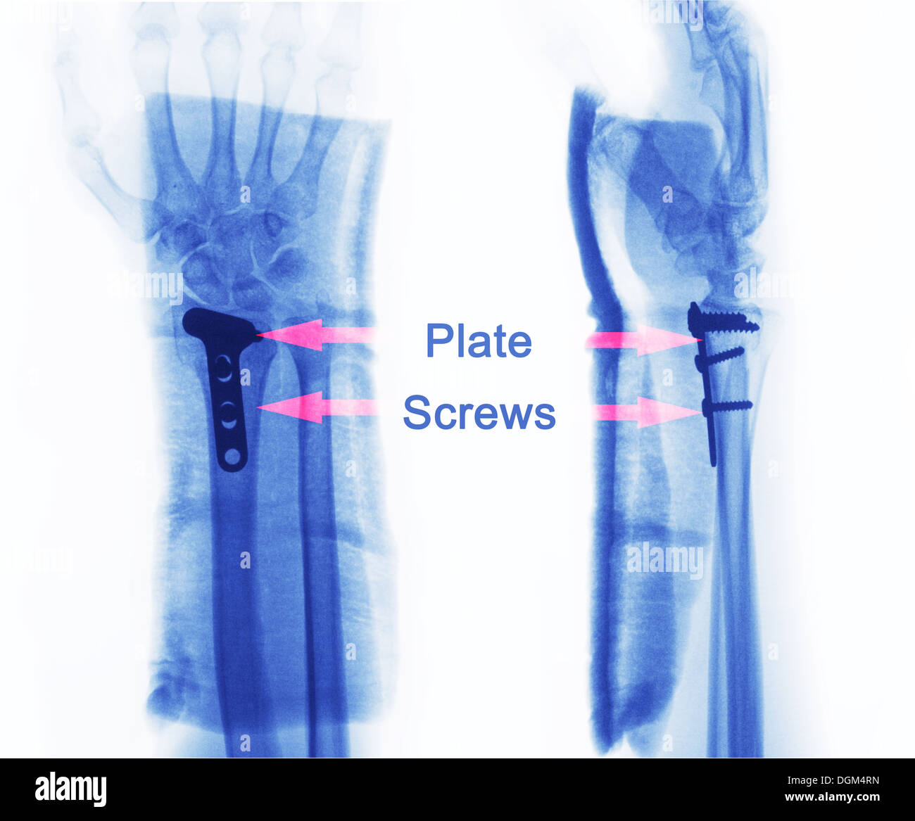 X-radiation (composed of X-rays) is a form of electromagnetic radiation ...