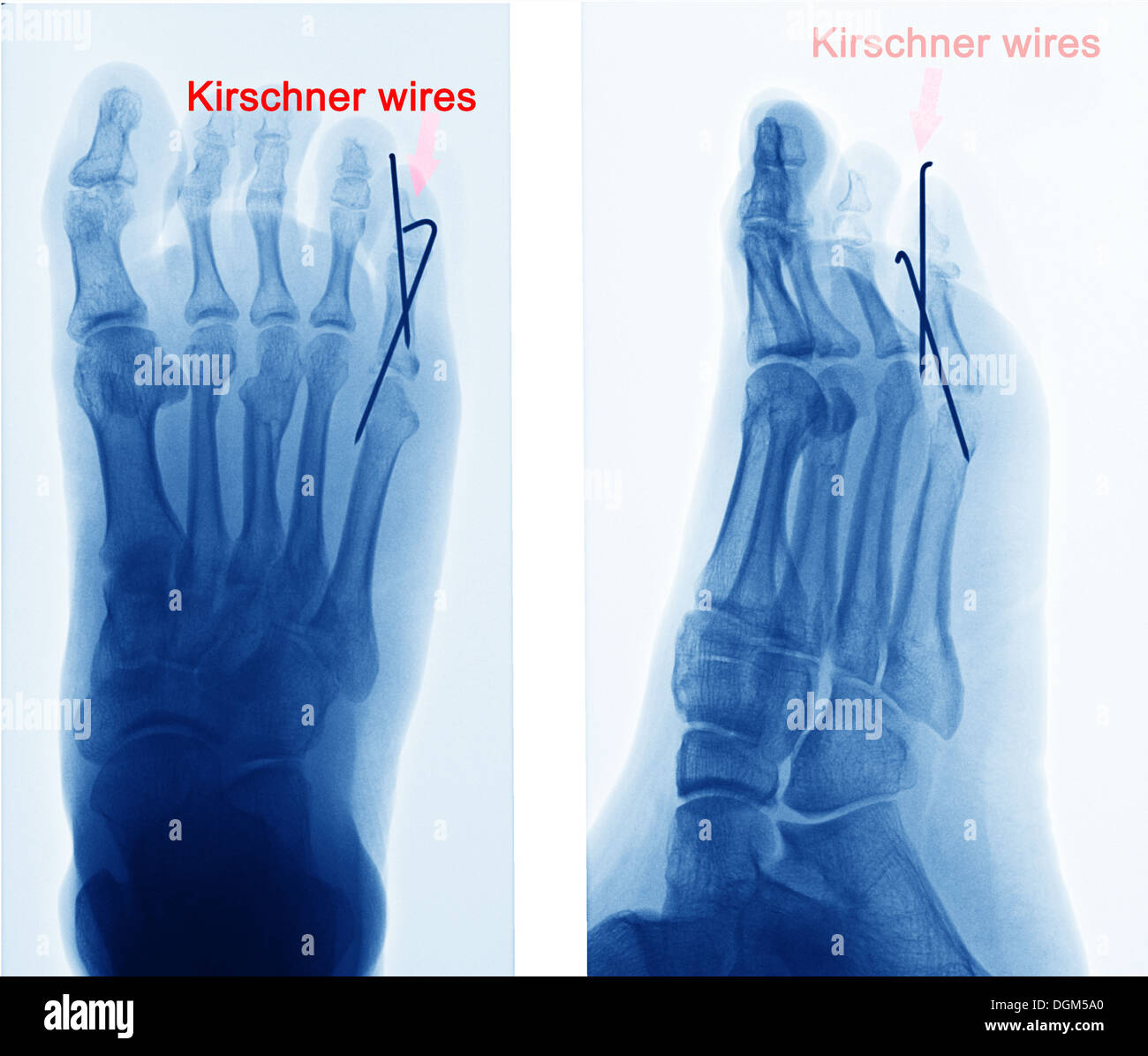 X-radiation (composed of X-rays) is a form of electromagnetic radiation ...