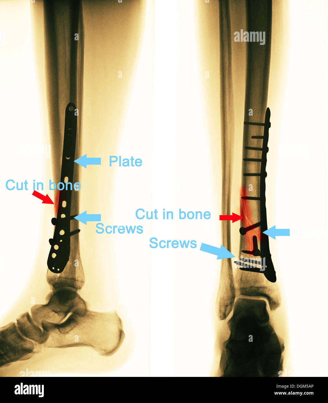 X-radiation (composed of X-rays) is a form of electromagnetic radiation ...