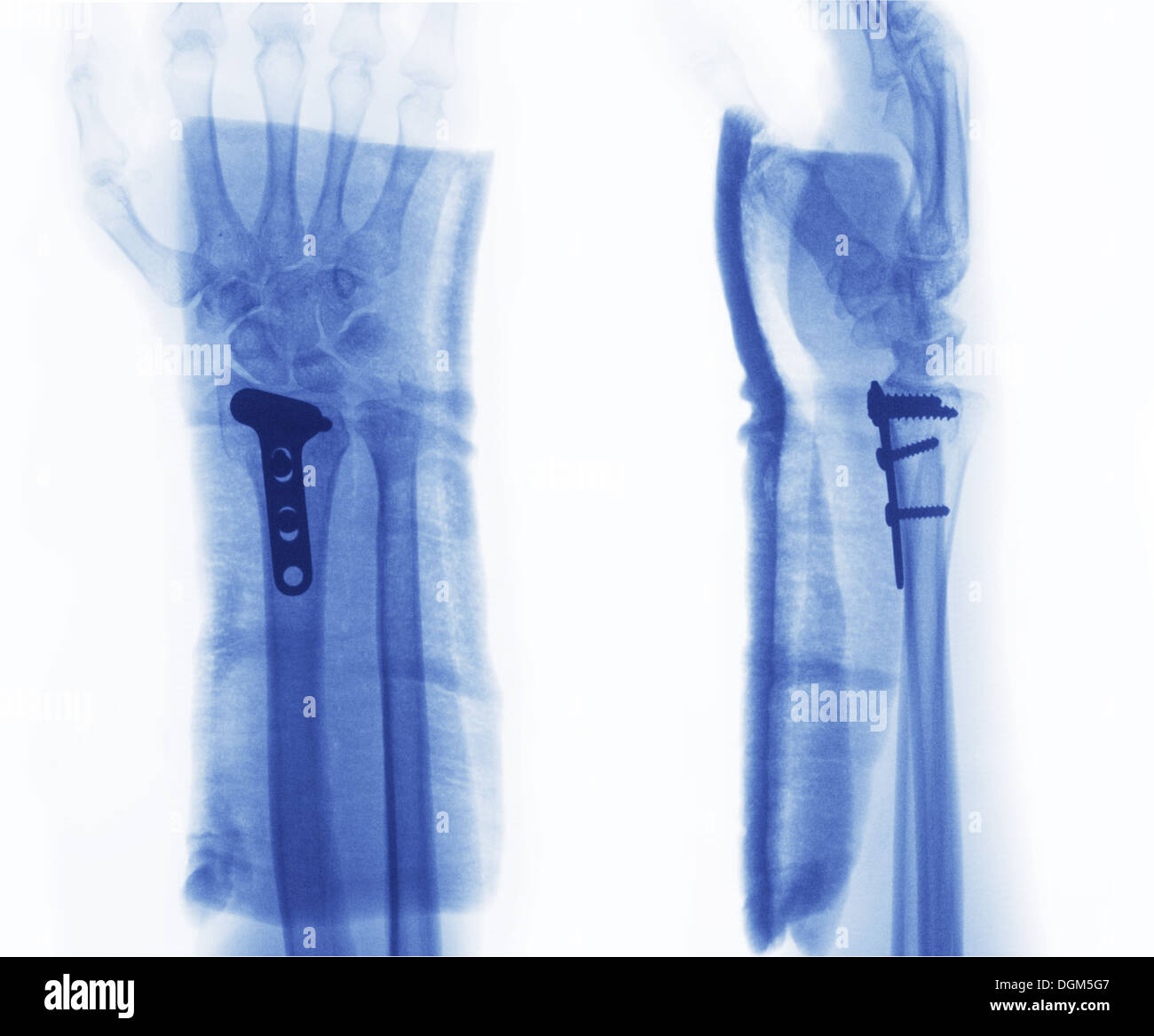 X-radiation (composed of X-rays) is a form of electromagnetic radiation ...