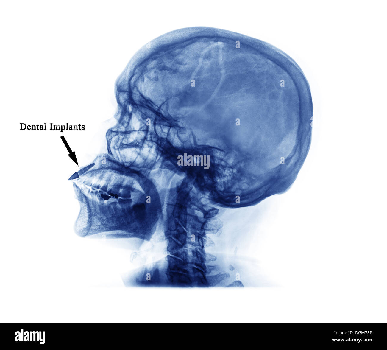 X-radiation (composed of X-rays) is a form of electromagnetic radiation ...