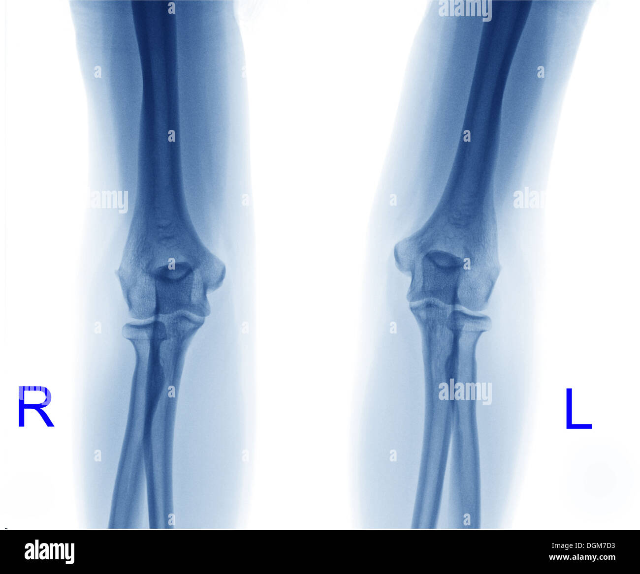 X-radiation (composed of X-rays) is a form of electromagnetic radiation ...
